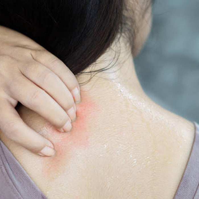 Chafing and Skin Irritation – Skift
